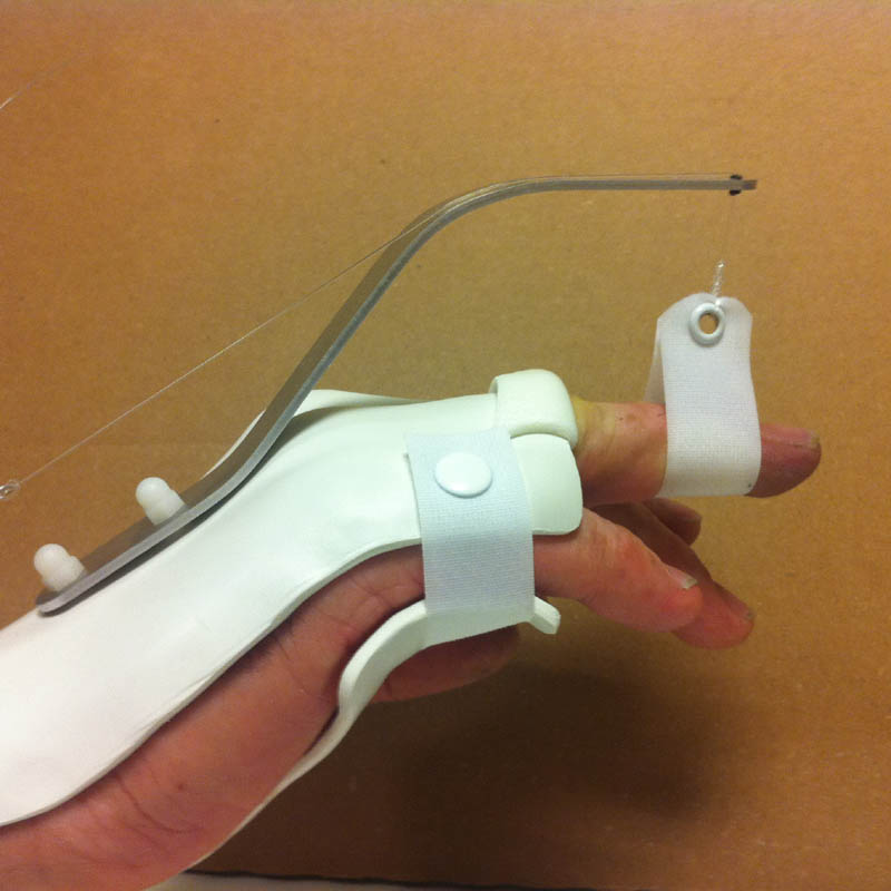 Les orthèses de la main et du poignet. | L'institut de chirurgie de la ...