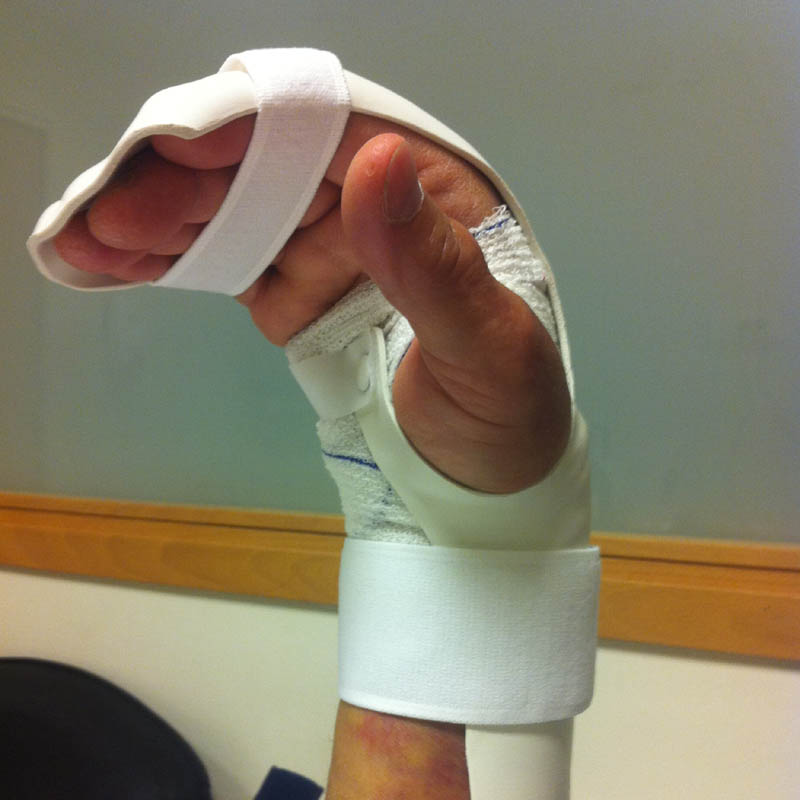 Les orthèses de la main et du poignet. | L'institut de chirurgie de la ...