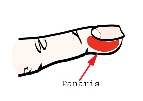 Panaris et phlegmon des gaines | L'institut de chirurgie de la main de ...